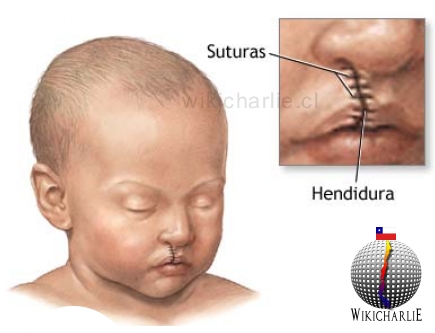 Disglosia - WikicharliE